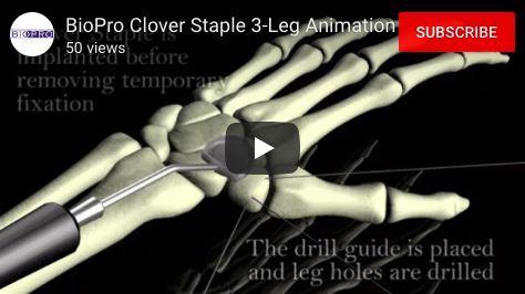 STT Animation - bioproimplants.com