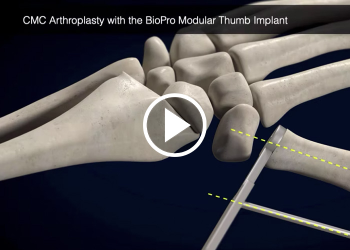CMC Arthroplasty with the Modular Thumb Implant Animation ...