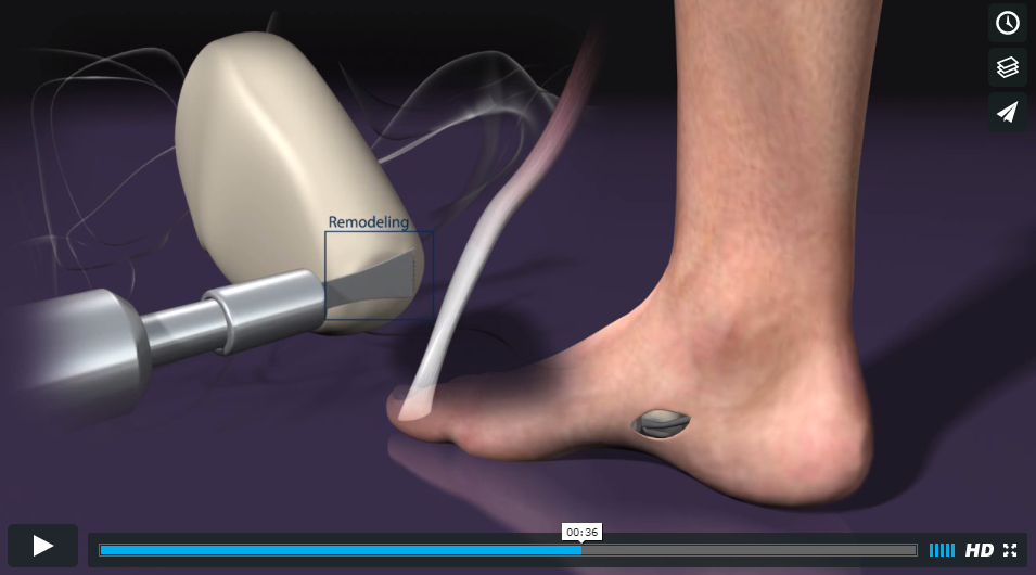 Kidner Animation - bioproimplants.com