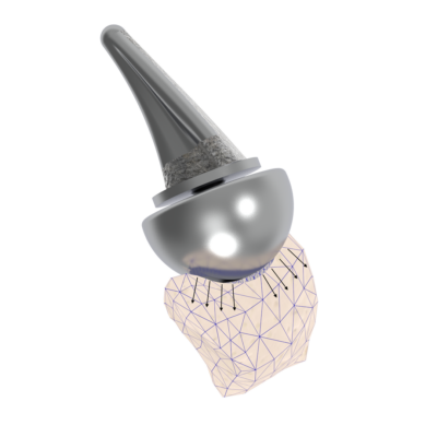 CMC Joint Replacement - The BioPro Modular Thumb Implant