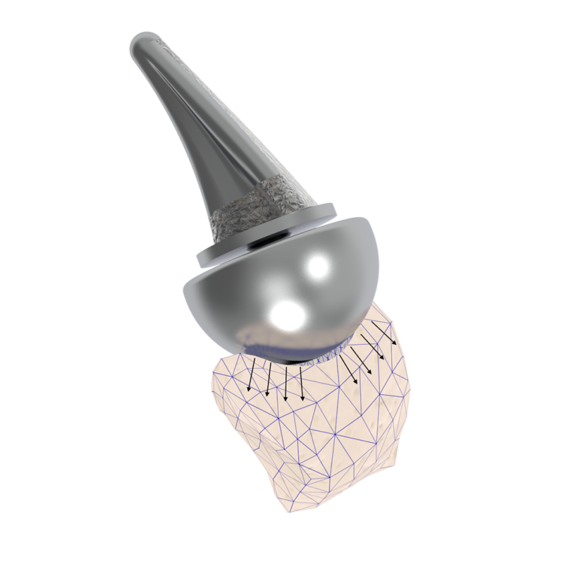 CMC Joint Replacement - The BioPro Modular Thumb Implant