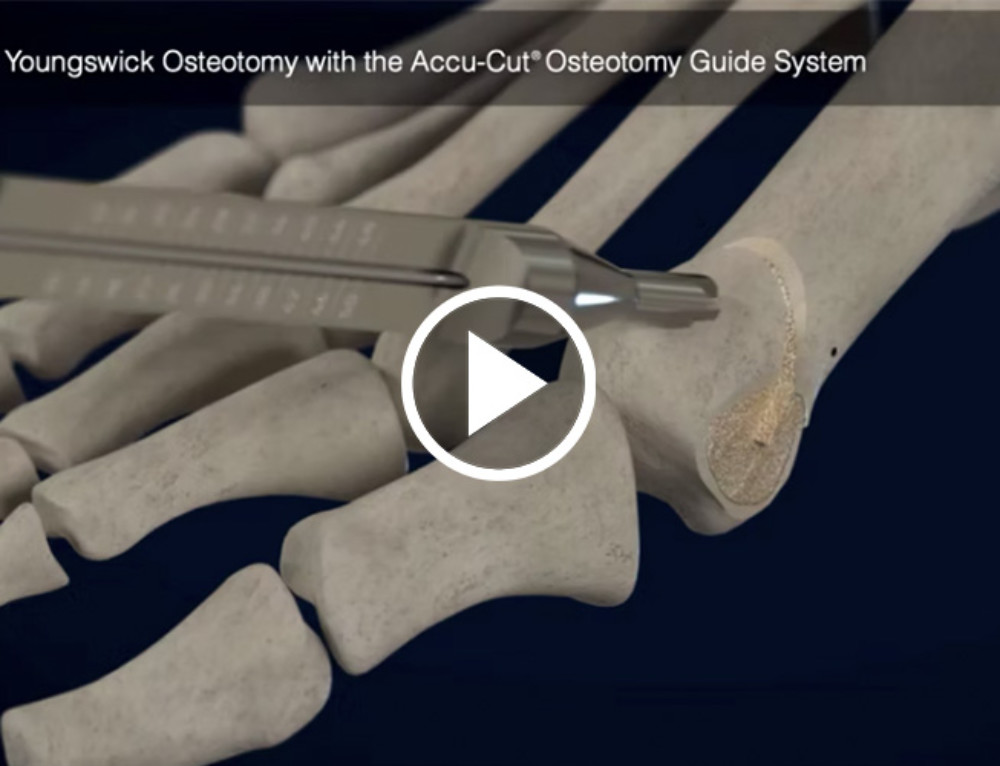 Youngswick Osteotomy Procedure with the Accu-Cut Osteotomy Guide System ...