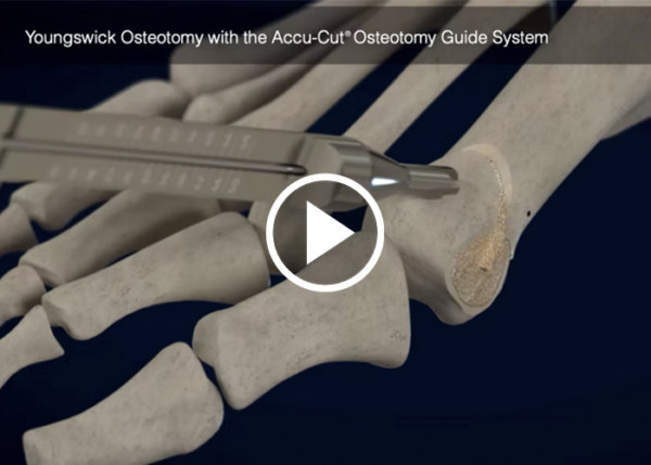 Procedure Videos - bioproimplants.com