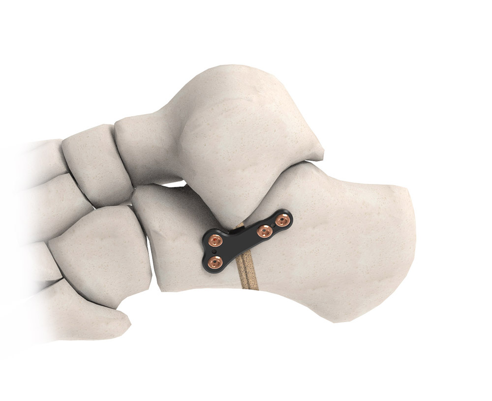 Foot Plating System - bioproimplants.com