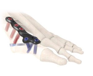 Foot Plating System - bioproimplants.com