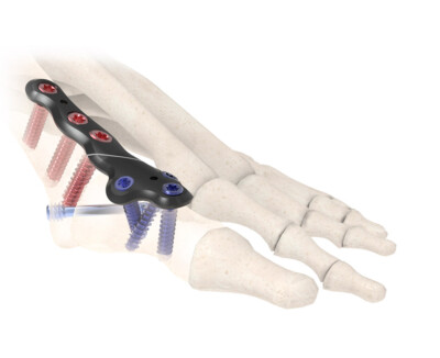 Foot Plating System - bioproimplants.com