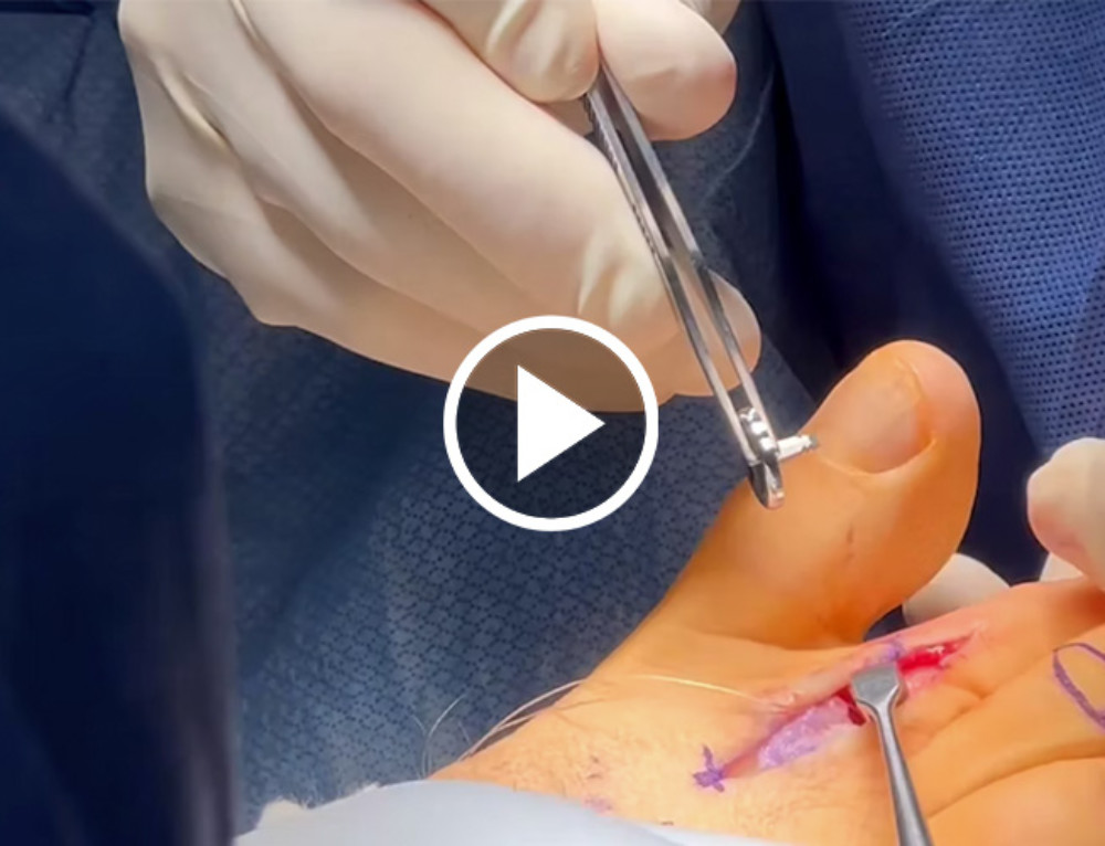 Youngswick Osteotomy Procedure with the Accu-Cut Osteotomy Guide System ...