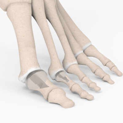 Foot & Ankle Archives - bioproimplants.com