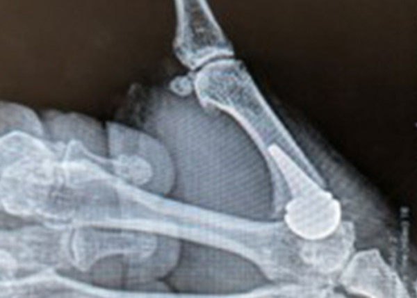 Patient Stories - bioproimplants.com