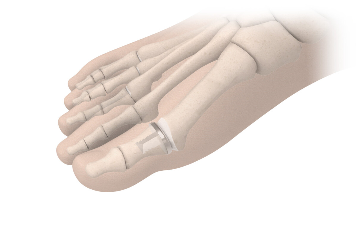 BioPro Hemi Toe Implant for Hallux Rigidus - bioproimplants.com