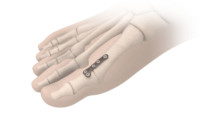 BioPro Hemi Toe Implant for Hallux Rigidus - bioproimplants.com
