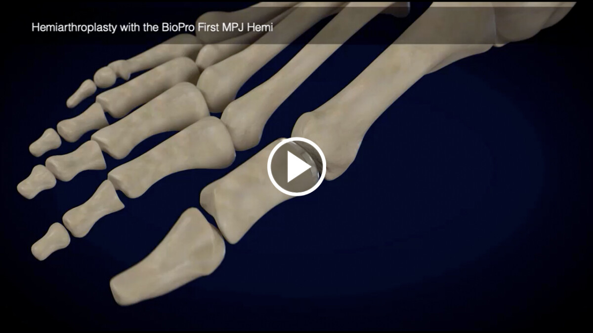 Fasciotome Animation - bioproimplants.com