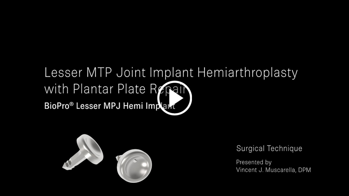 First MPJ Hemiarthroplasty with the First MPJ Hemi Implant ...