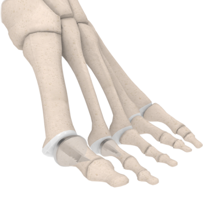 A Proven Hallux Rigidus Solution: The BioPro First MPJ Hemi Implant