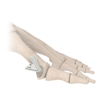 BioPro Implants | Proven Extremity Implant Solutions