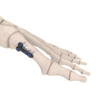Forefoot/Midfoot/Hindfoot Plating System - bioproimplants.com