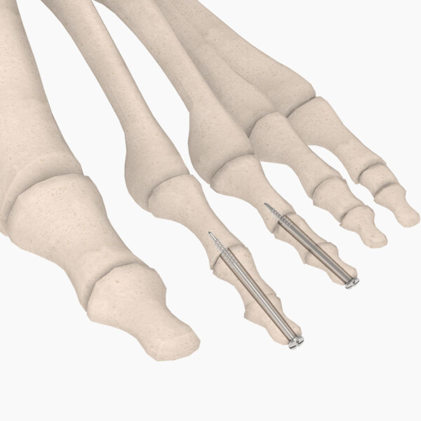 Products - bioproimplants.com