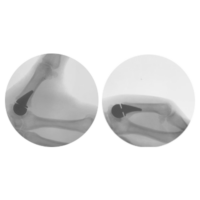 CMC Joint Replacement - The BioPro Modular Thumb Implant
