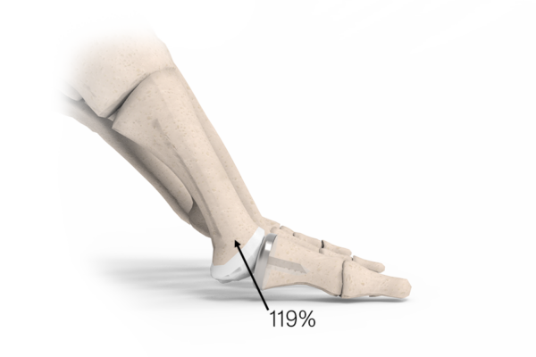 A Proven Hallux Rigidus Solution: The BioPro First MPJ Hemi Implant