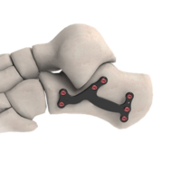 Forefoot/Midfoot/Hindfoot Plating System - bioproimplants.com