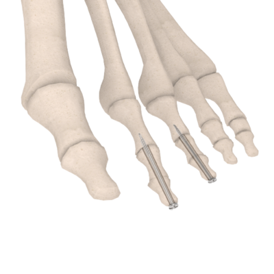 Hammertoe Correction - Digital Compression Screw