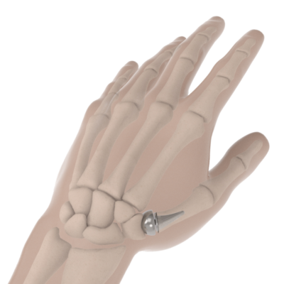 Thumb Arthritis - bioproimplants.com