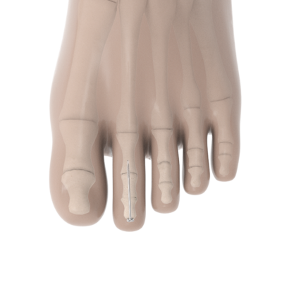 Patients - bioproimplants.com